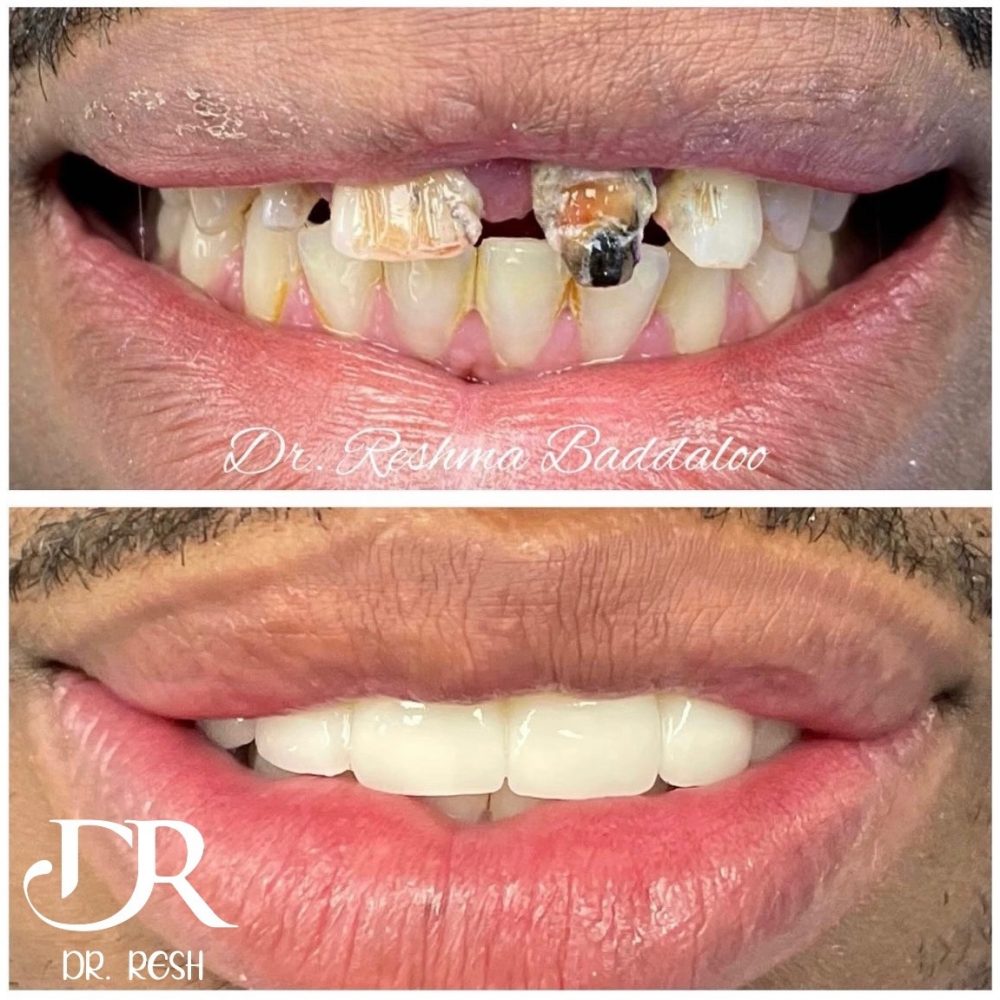 Smile Gallery - Dr. Reshma Baddaloo